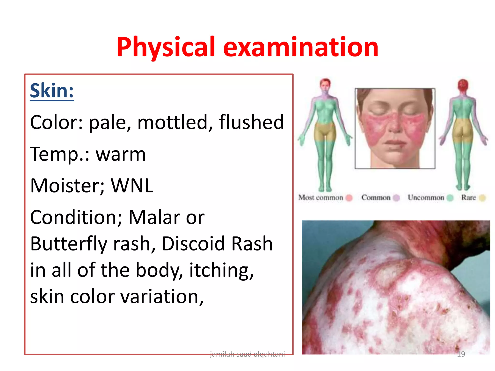 Systemic Lupus Erythematous (SLE) | PPTX