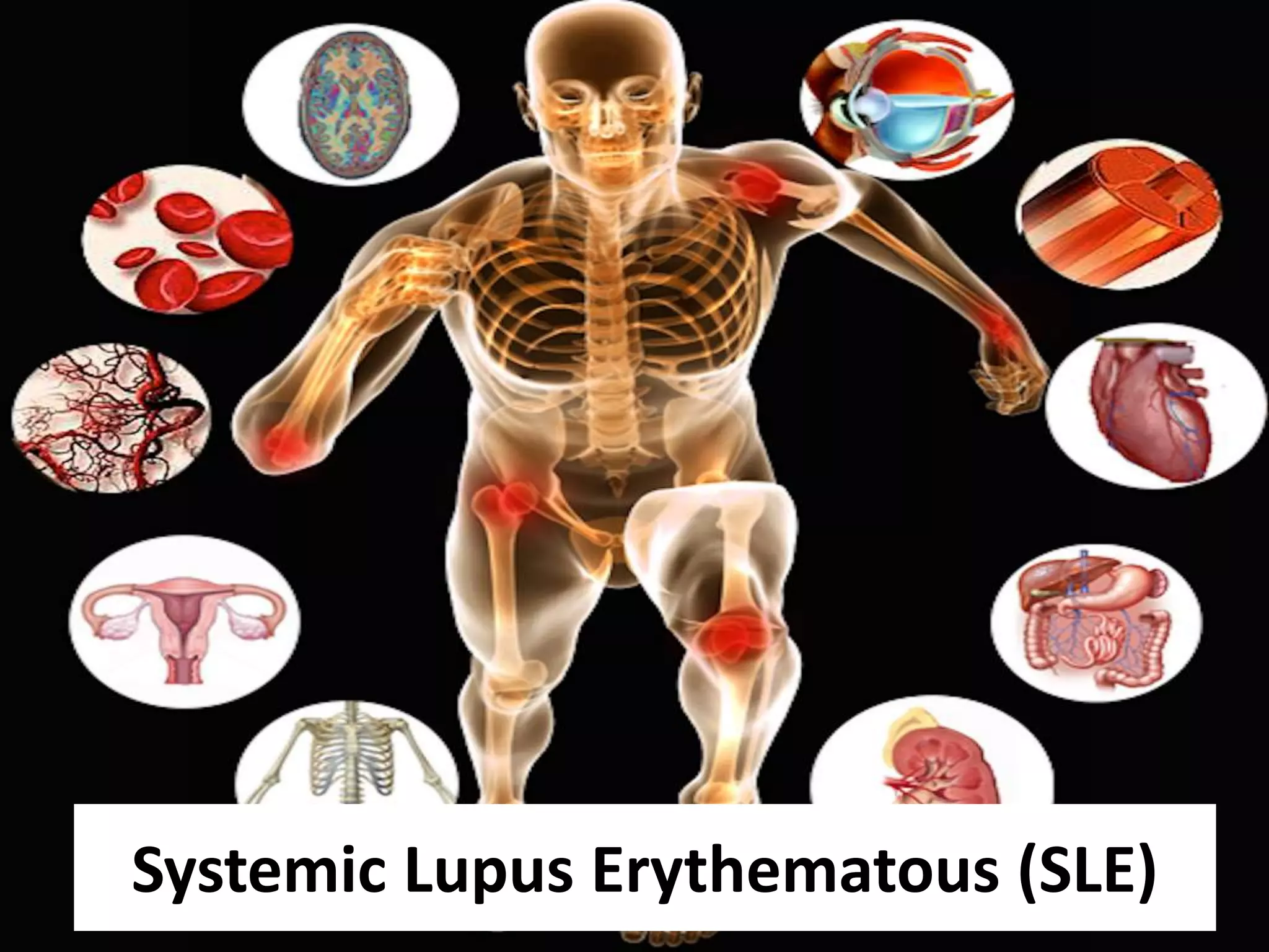 Systemic Lupus Erythematous (SLE) | PPTX