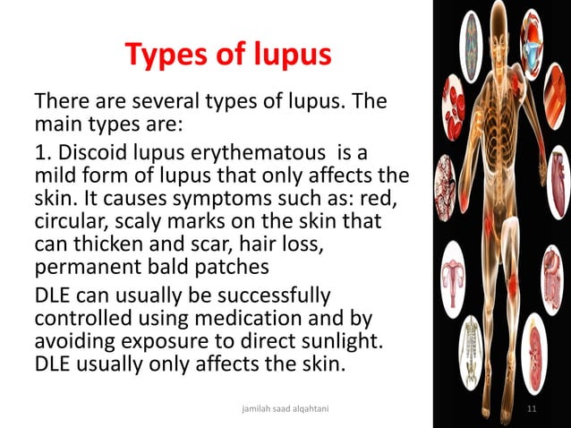 Systemic Lupus Erythematous (SLE) | PPTX