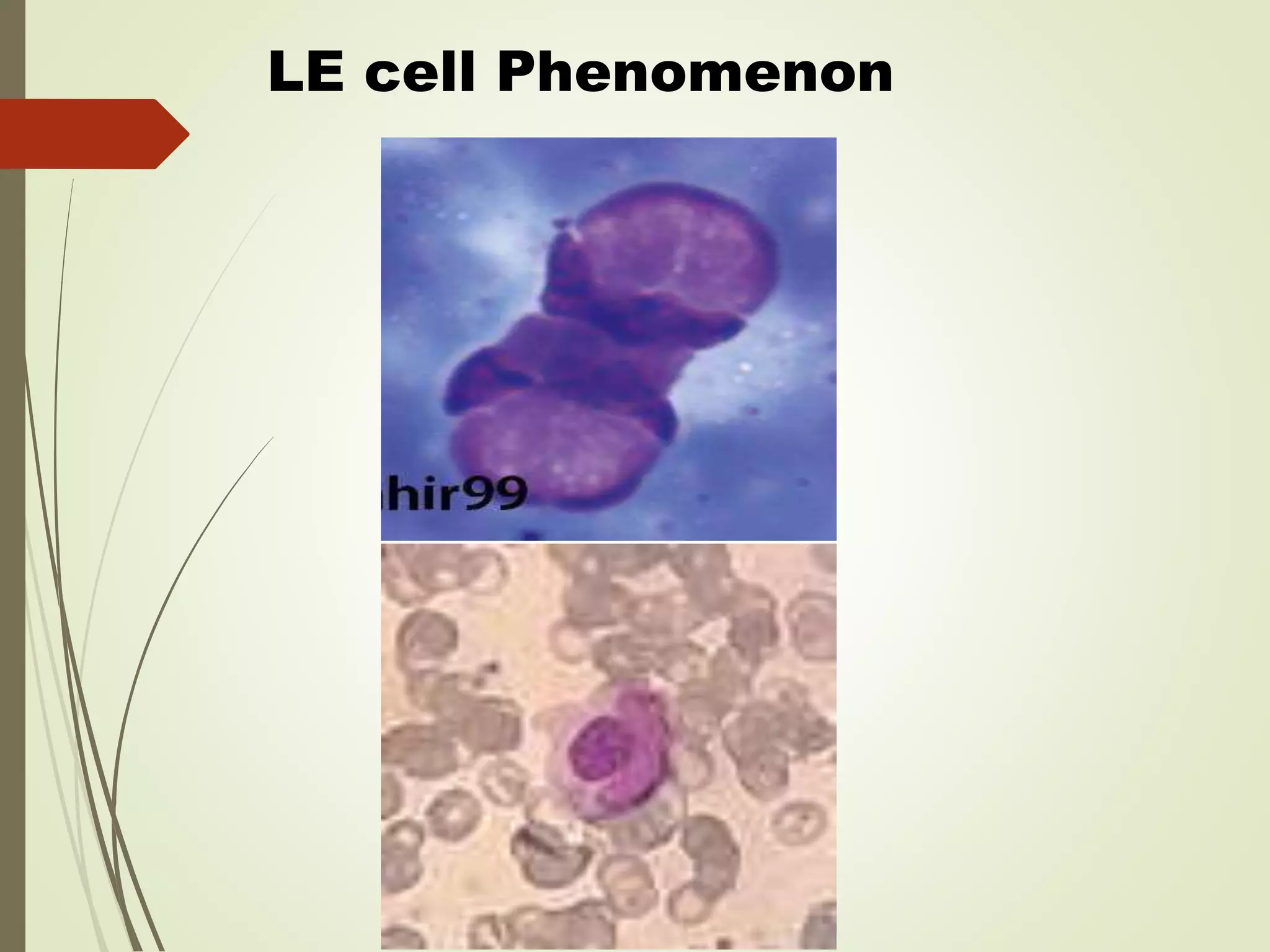 Systemic Lupus Erythematosis - SLE -Etiopathogenesis, Clinical features ...