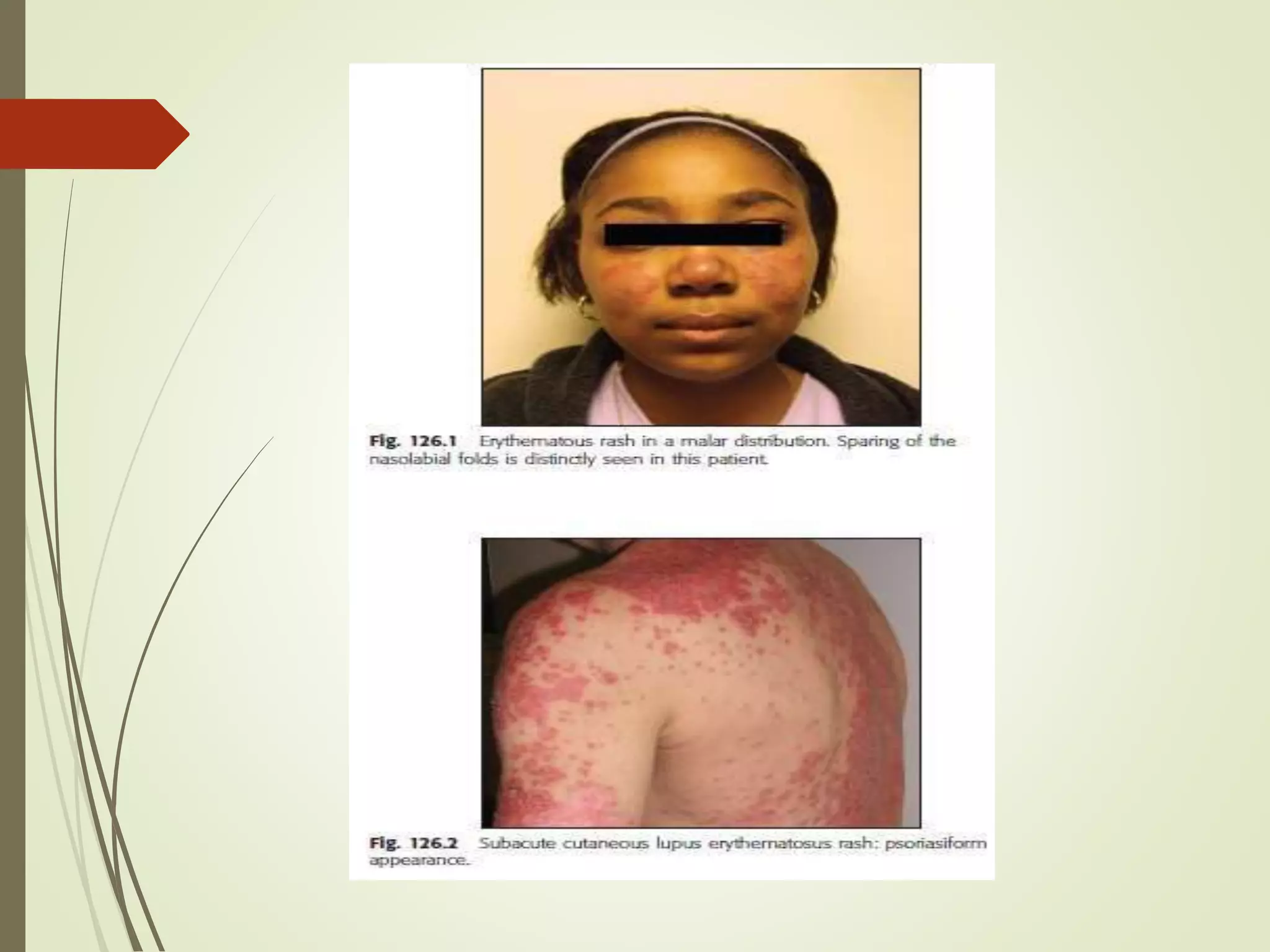 Systemic Lupus Erythematosis - SLE -Etiopathogenesis, Clinical features ...