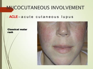 Systemic Lupus Erythematosis - SLE -Etiopathogenesis, Clinical features ...