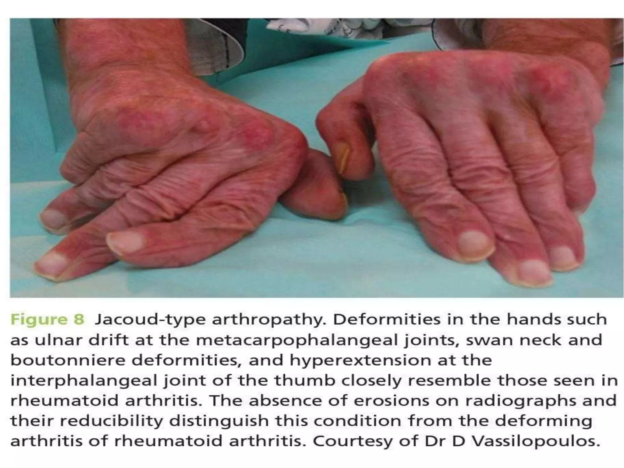 SYSTEMIC LUPUS ERYTHEMATOSUS (SLE | PPTX