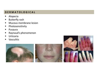 Clinical Pharmacotherapy of Systemic Lupus Erythematous | PPTX