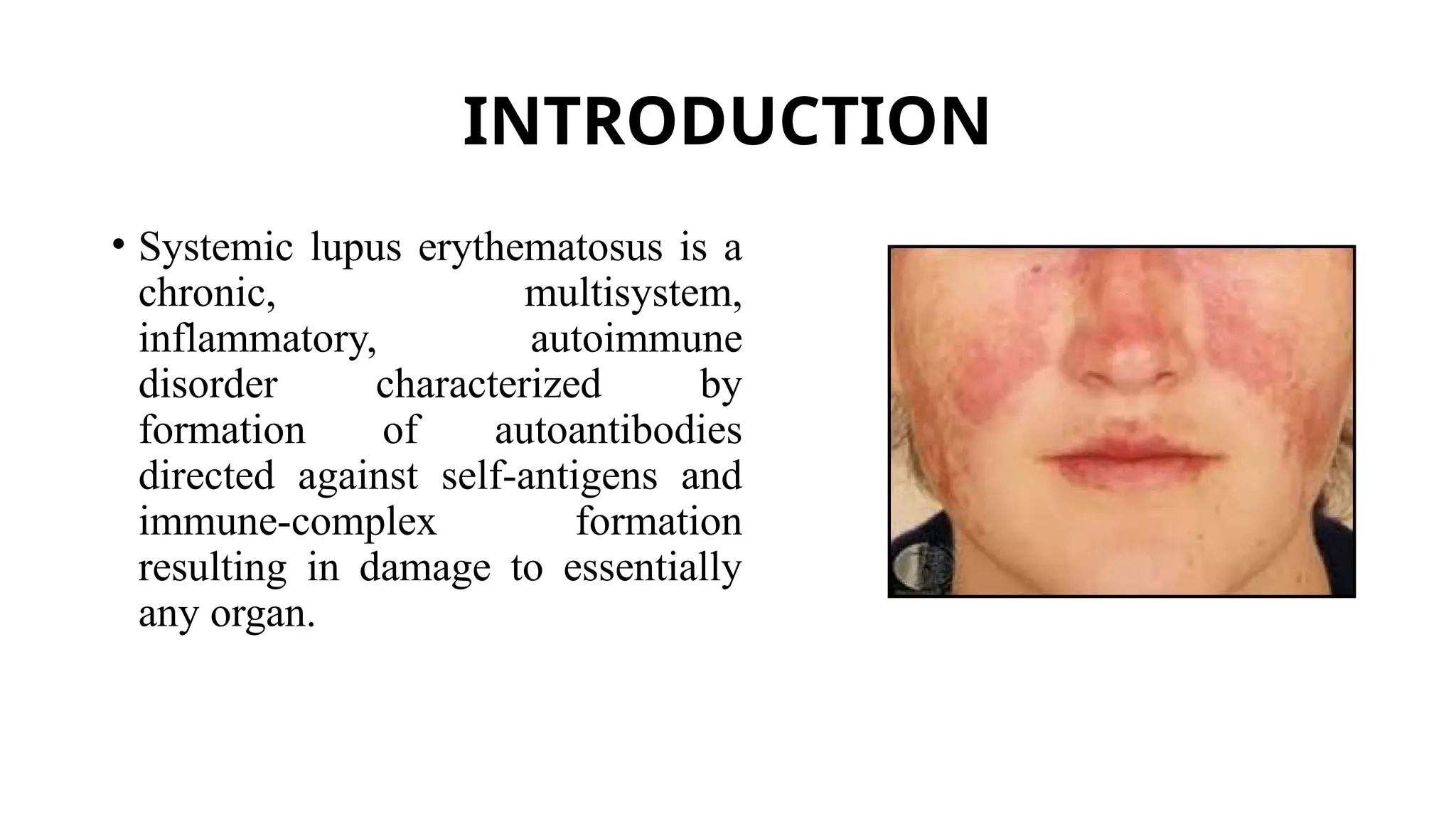 Systemic lupus erythematosus and its management | PPTX