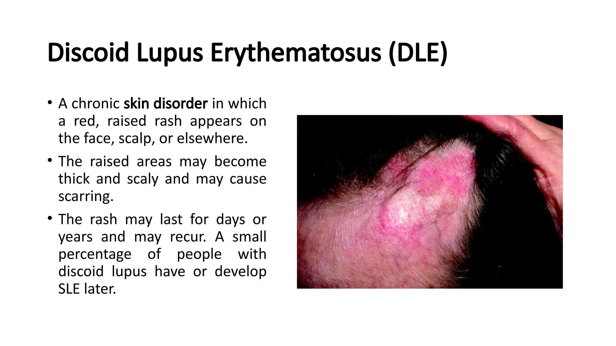 Systemic lupus erythematosus (SLE) & its Management | PPT