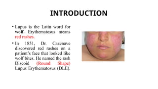 Systemic lupus erythematosus (SLE) & its Management | PPT