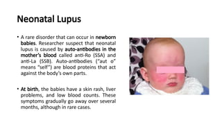 Systemic lupus erythematosus (SLE) & its Management | PPT