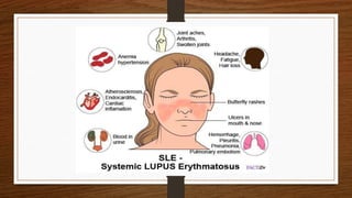 Systemic lupus erythematous SLE ppt.pptx