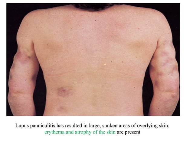 SYSTEMIC LUPUS ERYTHEMATOSUS .pptx dermatology | PPT