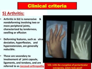 SLE & APS for undergraduates: diagnosis & treatment. | PDF