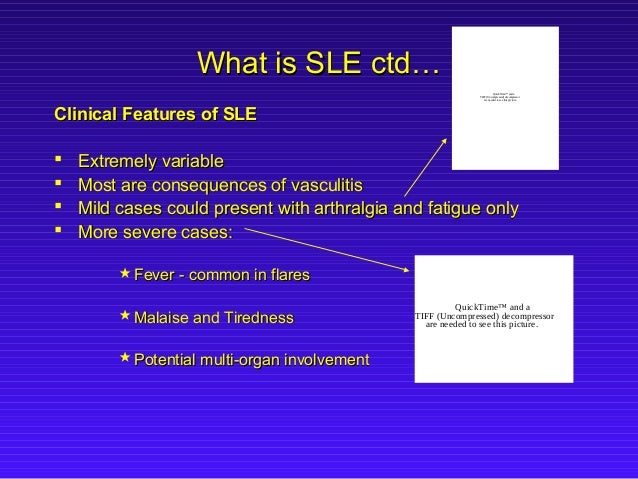 SLE: Case Presentation