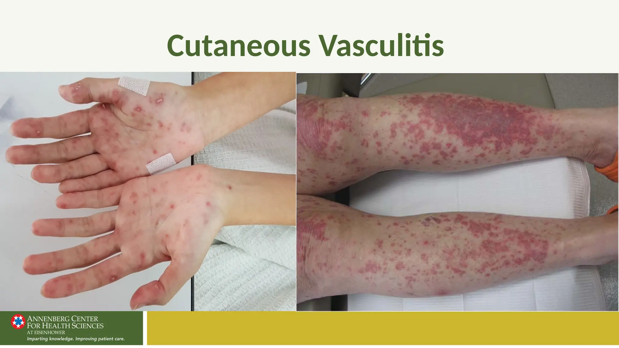 Systemic lupus erythematosus (SLE)/ Rheumatology | PPTX