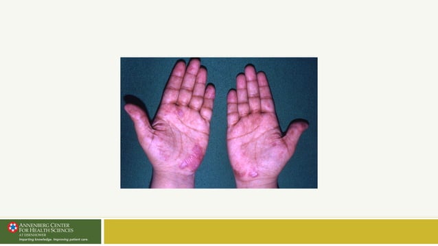 Systemic lupus erythematosus (SLE)/ Rheumatology | PPTX | Blood ...