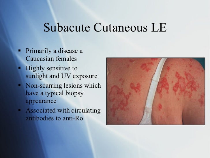 How do we diagnose lupus?