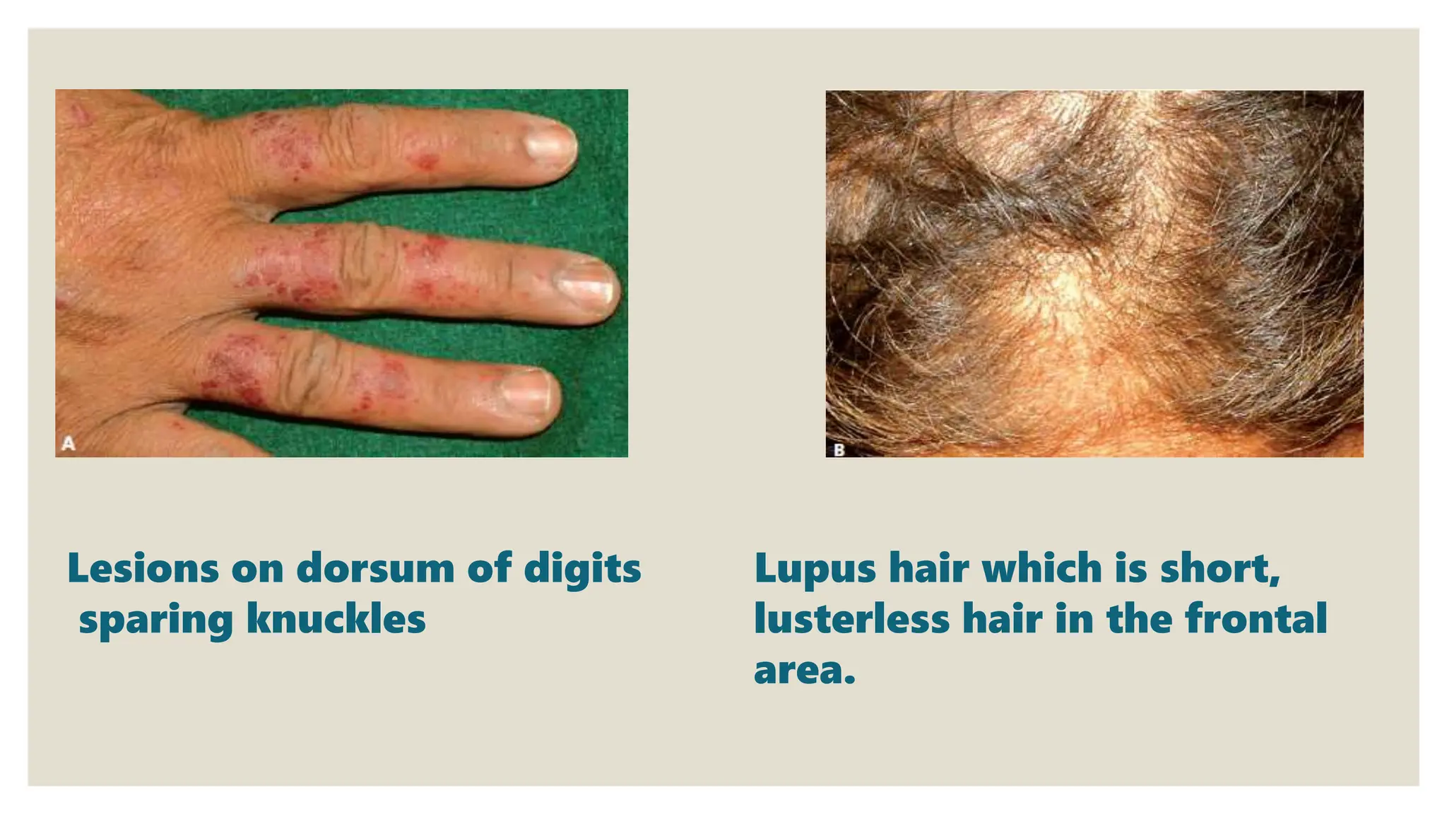SLE- SYSTEMIC LUPUS ERYTHEMATOUS...pptx. | PPTX