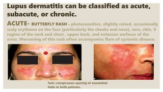 SLE- SYSTEMIC LUPUS ERYTHEMATOUS...pptx. | PPTX