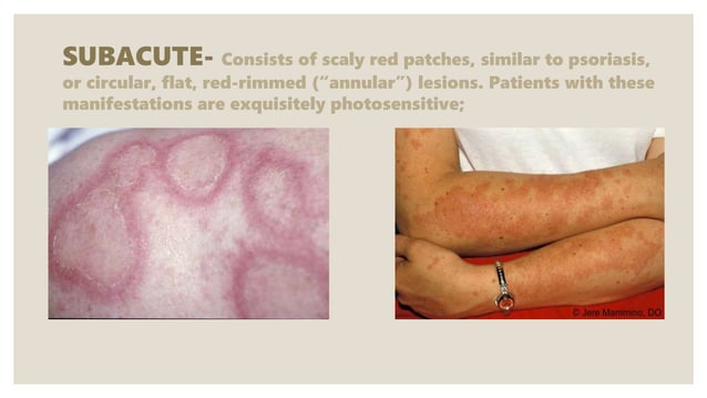 SLE- SYSTEMIC LUPUS ERYTHEMATOUS...pptx. | PPTX