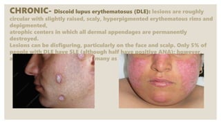 SLE- SYSTEMIC LUPUS ERYTHEMATOUS...pptx. | PPTX