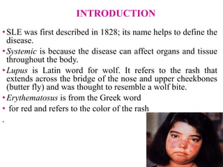 Systemic Lupus Erythematosus -SLE PT2.ppt