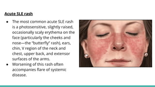 Clinical Manifestations of Systemic Lupus Erythematosus.pdf | Skin and ...