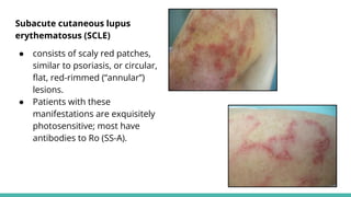 Clinical Manifestations of Systemic Lupus Erythematosus.pdf | Skin and ...
