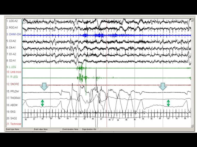 Sleep Study Interpretation | PPT