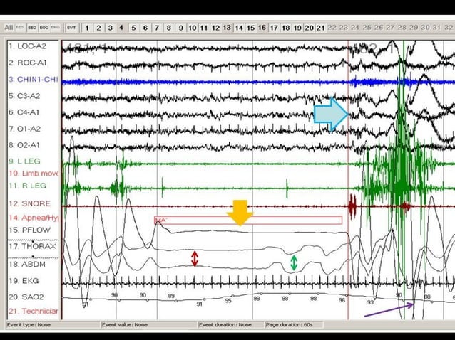 Sleep Study Interpretation | PPT