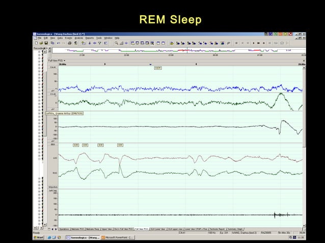 Sleep Study Interpretation | PPT