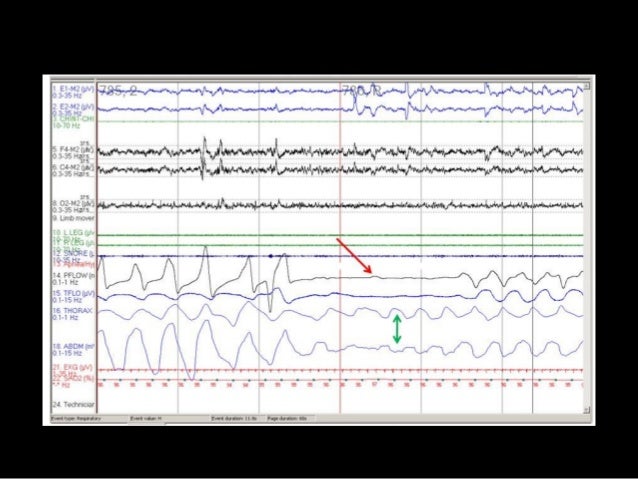 Sleep Study Interpretation