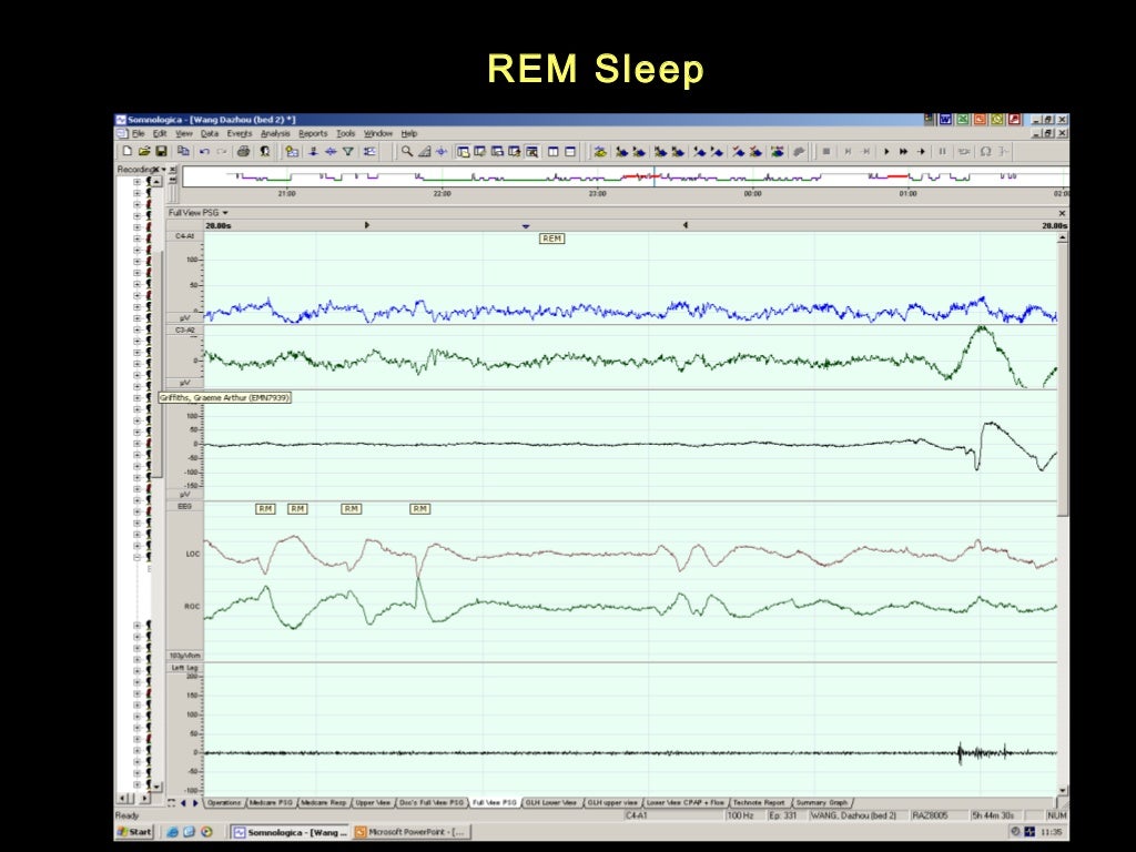 Sleep Study Interpretation Chart – Brezelbruder