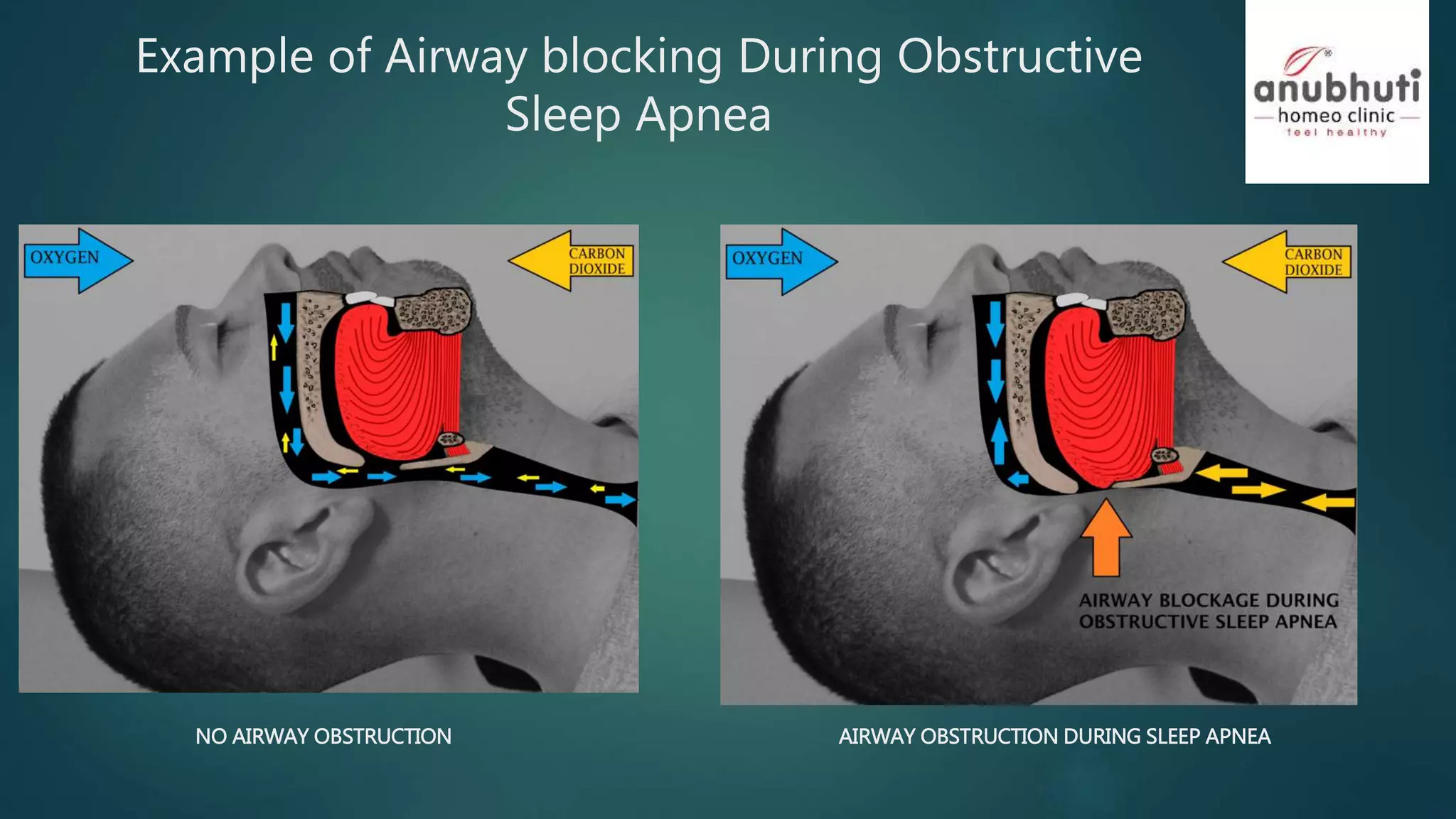 Sleep apnea and homeopathy treatment | PPTX