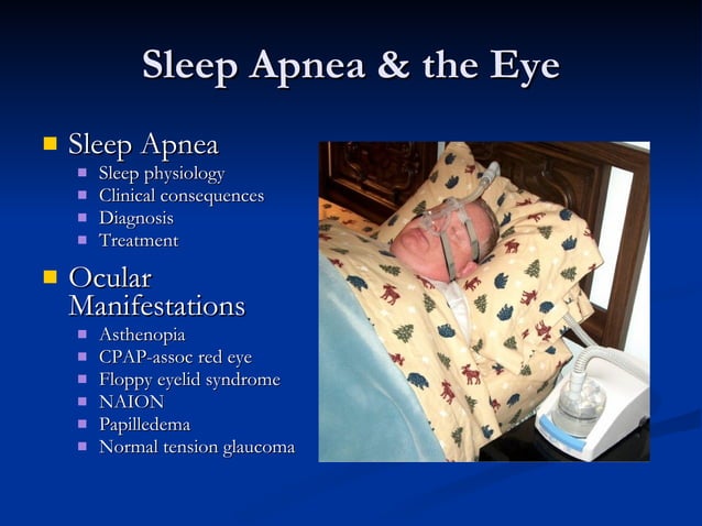 Sleep Apnea and the Eye - 2008 | PPT