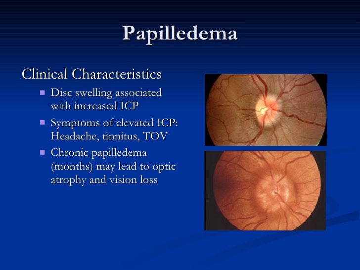 Sleep Apnea and the Eye - 2008