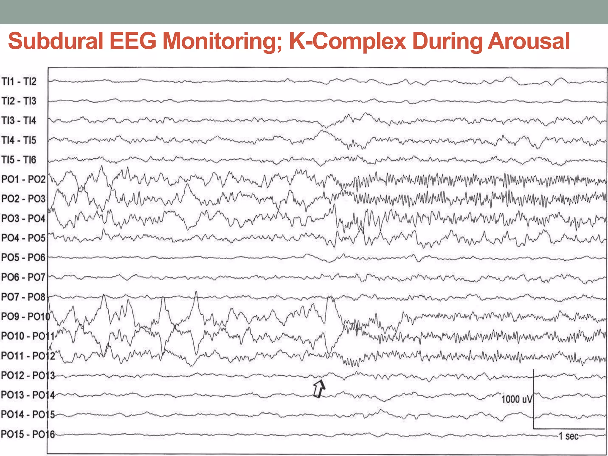 Sleep activity in eeg | PPTX