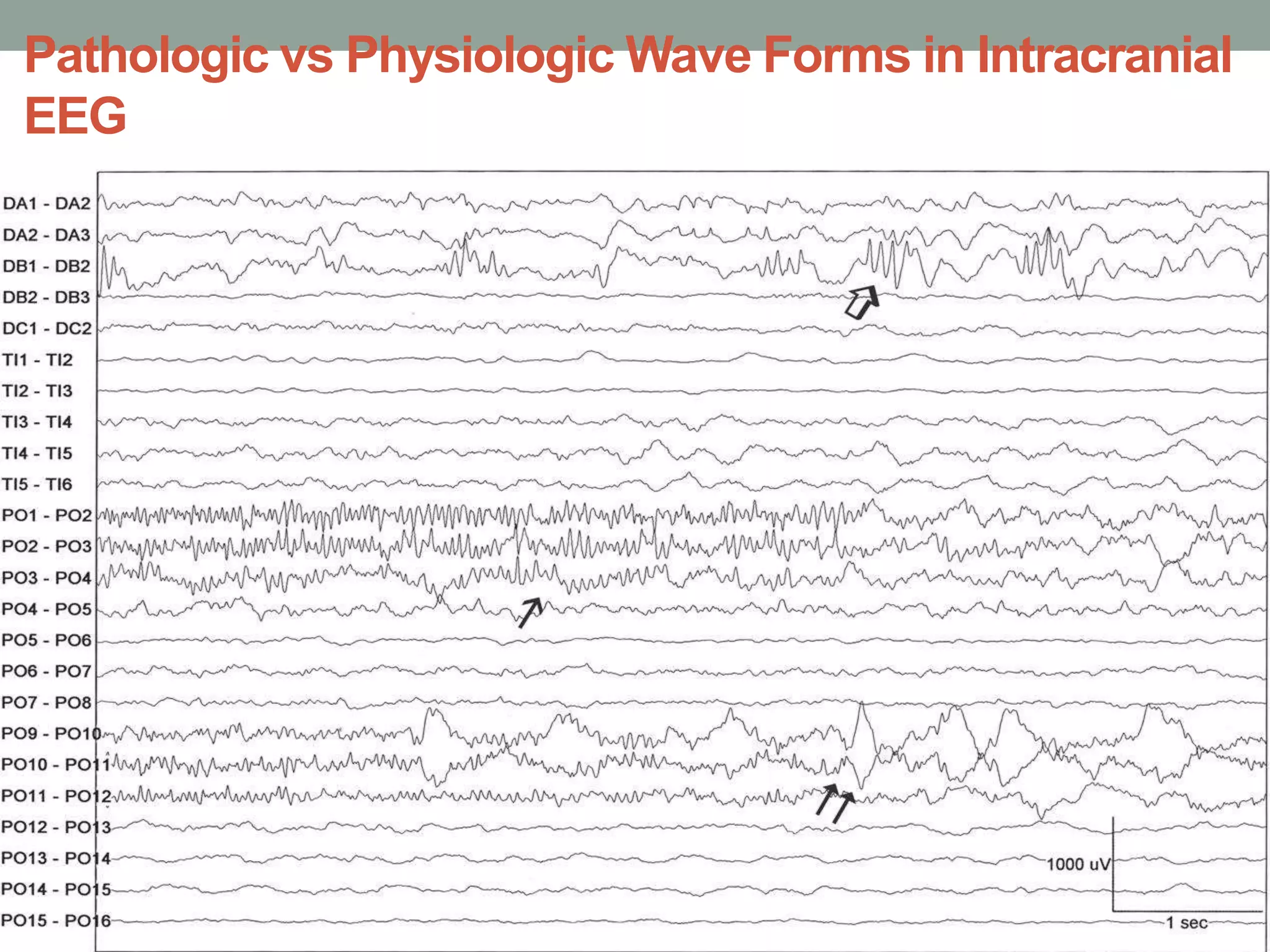 Sleep activity in eeg | PPTX
