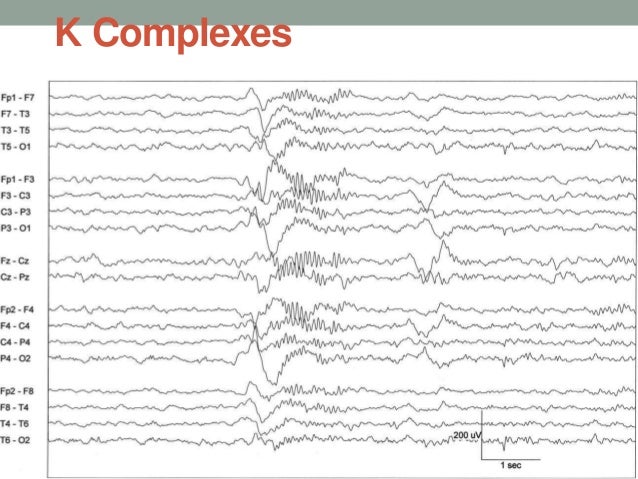 Sleep activity in eeg