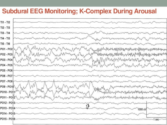 Sleep activity in eeg
