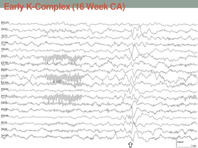 Sleep activity in eeg