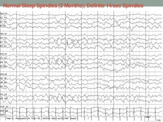 Sleep activity in eeg