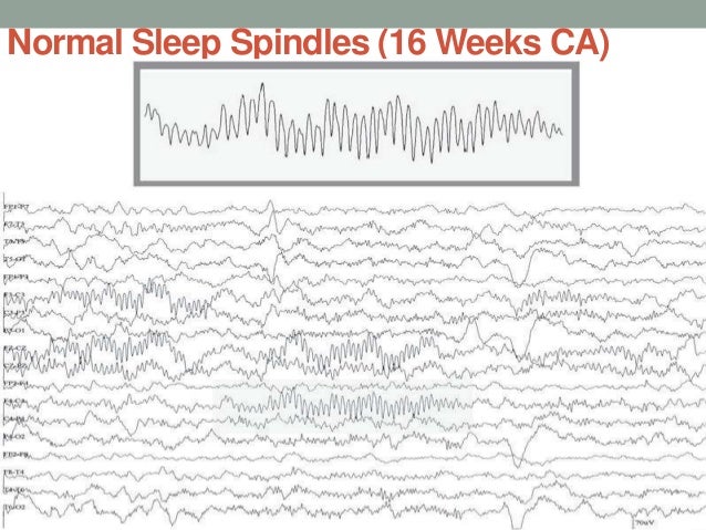 Sleep activity in eeg