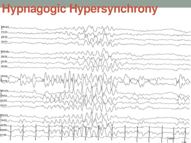 Sleep activity in eeg