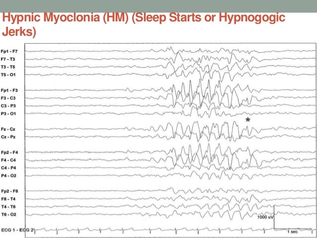 Sleep activity in eeg