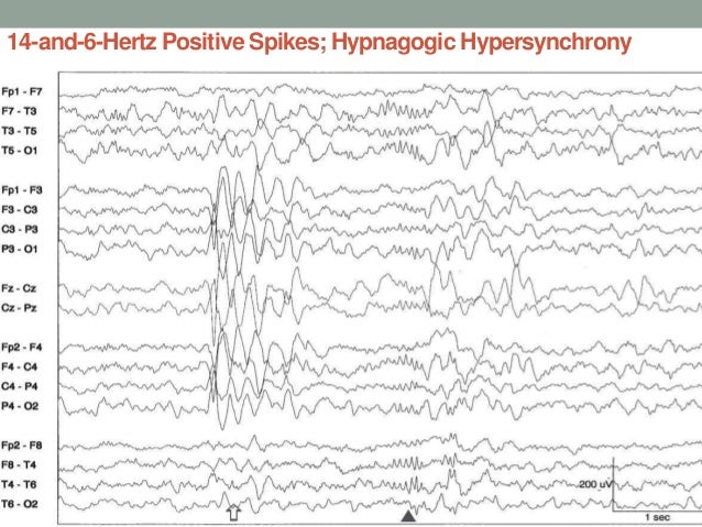 Sleep activity in eeg