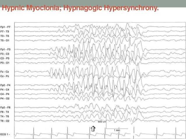 Sleep Activity In Eeg