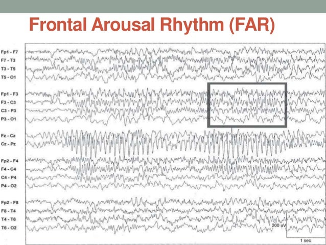 Sleep activity in eeg