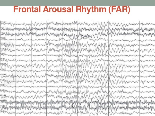 Sleep activity in eeg