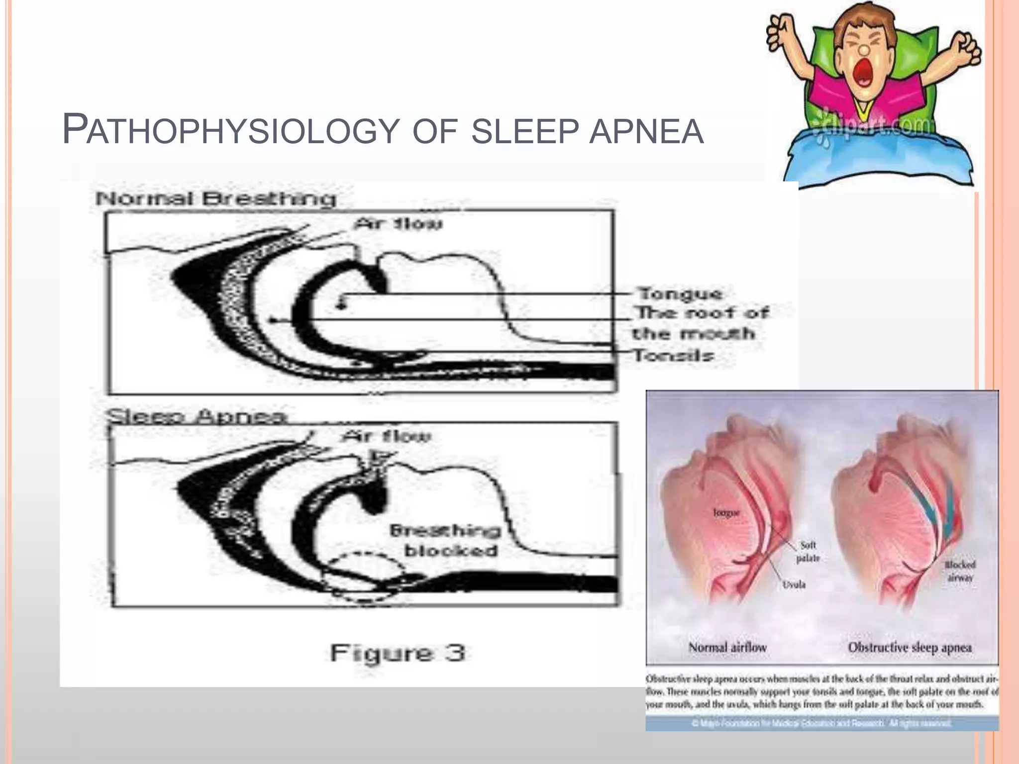Sleep and sleep disorders | PPTX