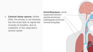 Sleep apnea | PPT