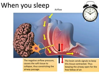 Sleep apnea | PPTX